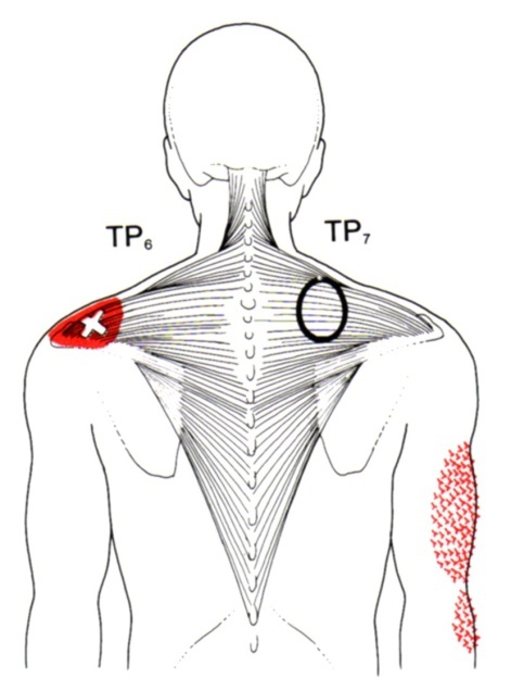 Trapezius The Trigger Point Referred Pain Guide